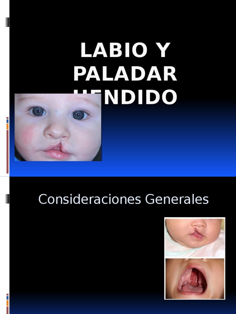 Labio Paladar Hendido | PDF | Dentadura postiza | Odontología
