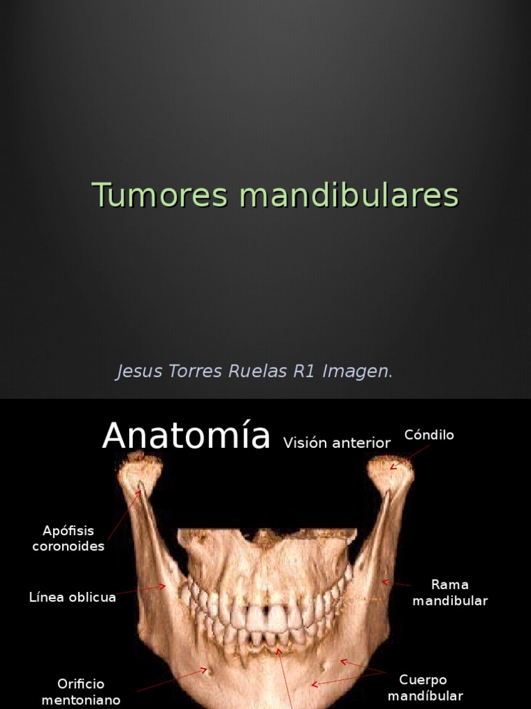 Tumores Mandibulares | PDF | Diente humano | Especialidades Medicas