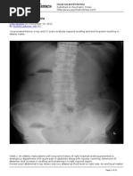 Reduction en Masse of Inguinal Hernia | PDF | Medicine | Causes Of Death