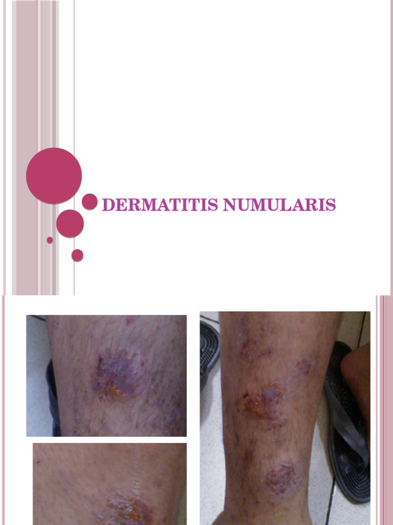 Dermatitis Numularis | PDF