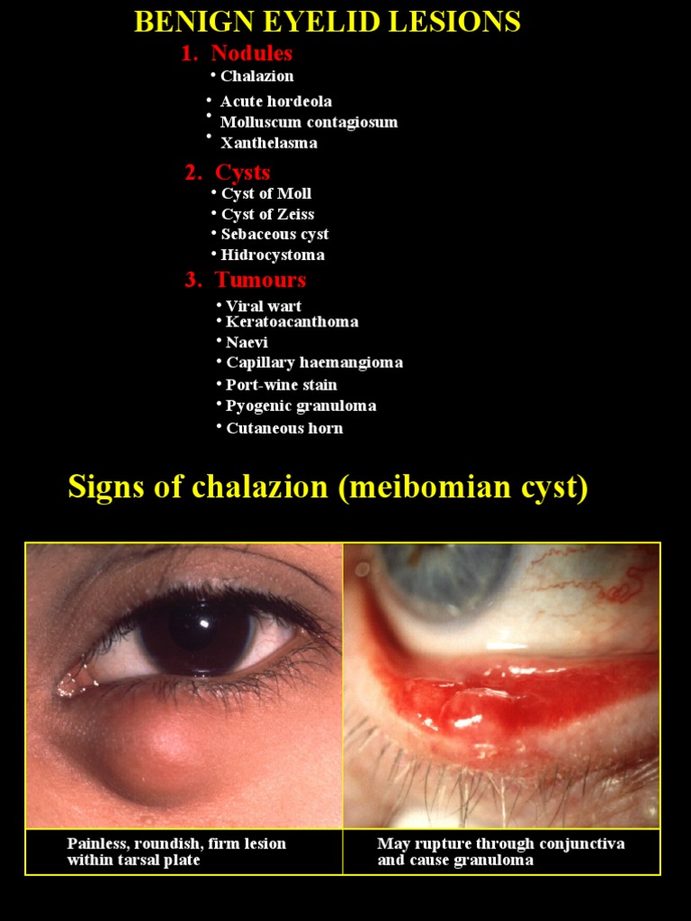 1 Nodules • Chalazion • Acute Hordeola