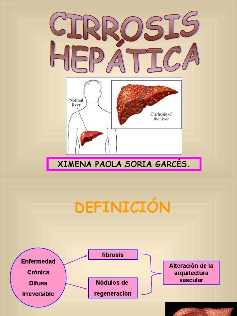 Cirrosis hepatica y complicaciones | Cirrosis | Hepatitis