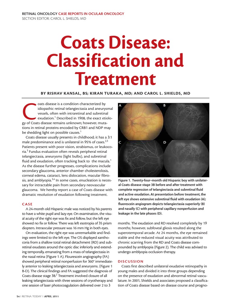Coats Disease: Classification and Treatment: by Rishav Kansal, Bs Kiran ...