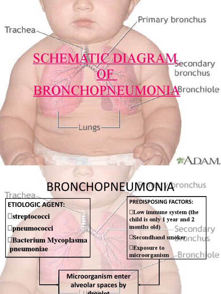 Schematic Diagram OF Bronchopneumonia | PDF | Pulmonology | Lung