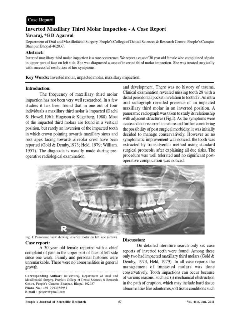 Inverted Maxillary Third Molar Case Report | PDF