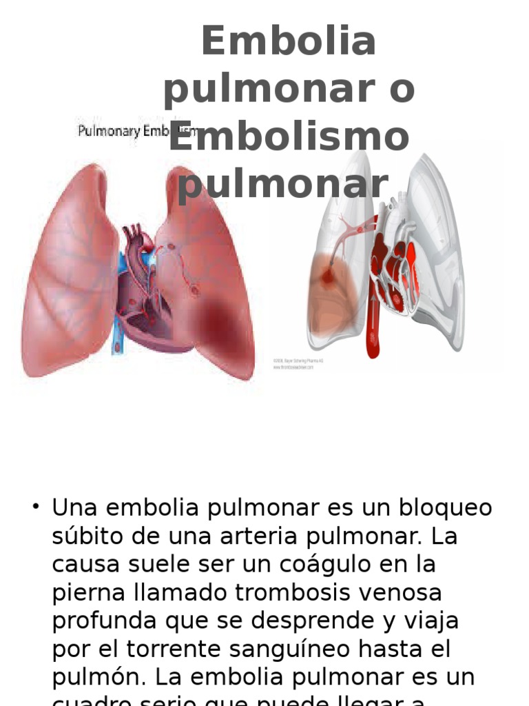 embolia pulmonar | Embolia | Trombo