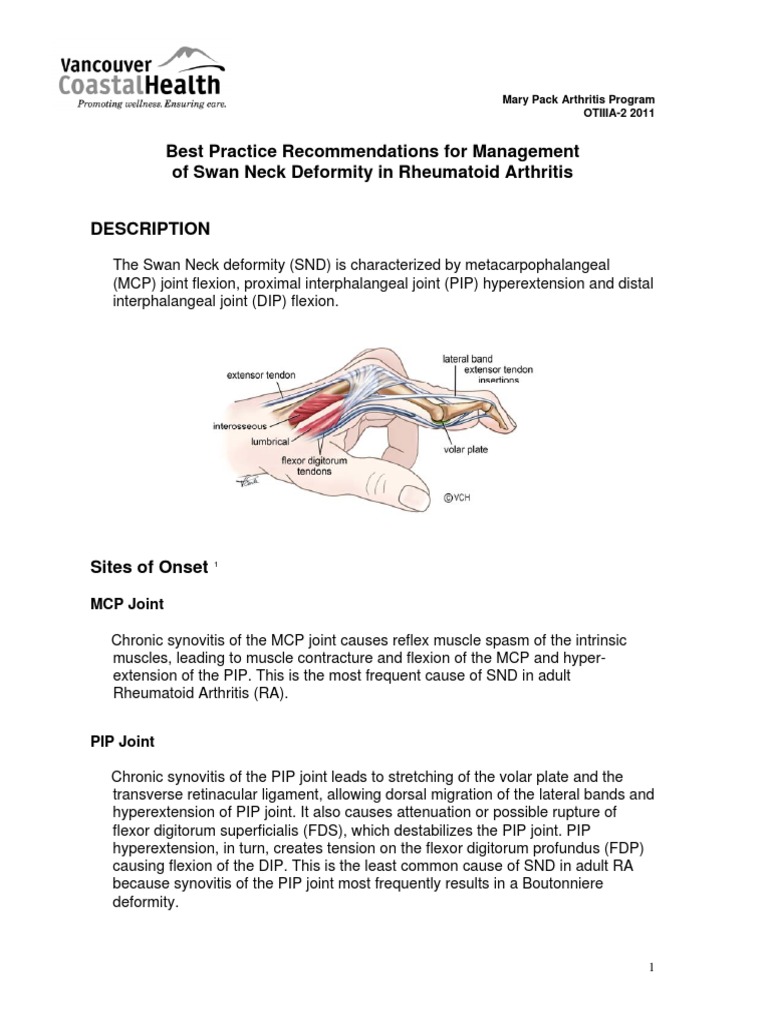 Best Practice Recommendations For Management of Swan Neck Deformity in ...