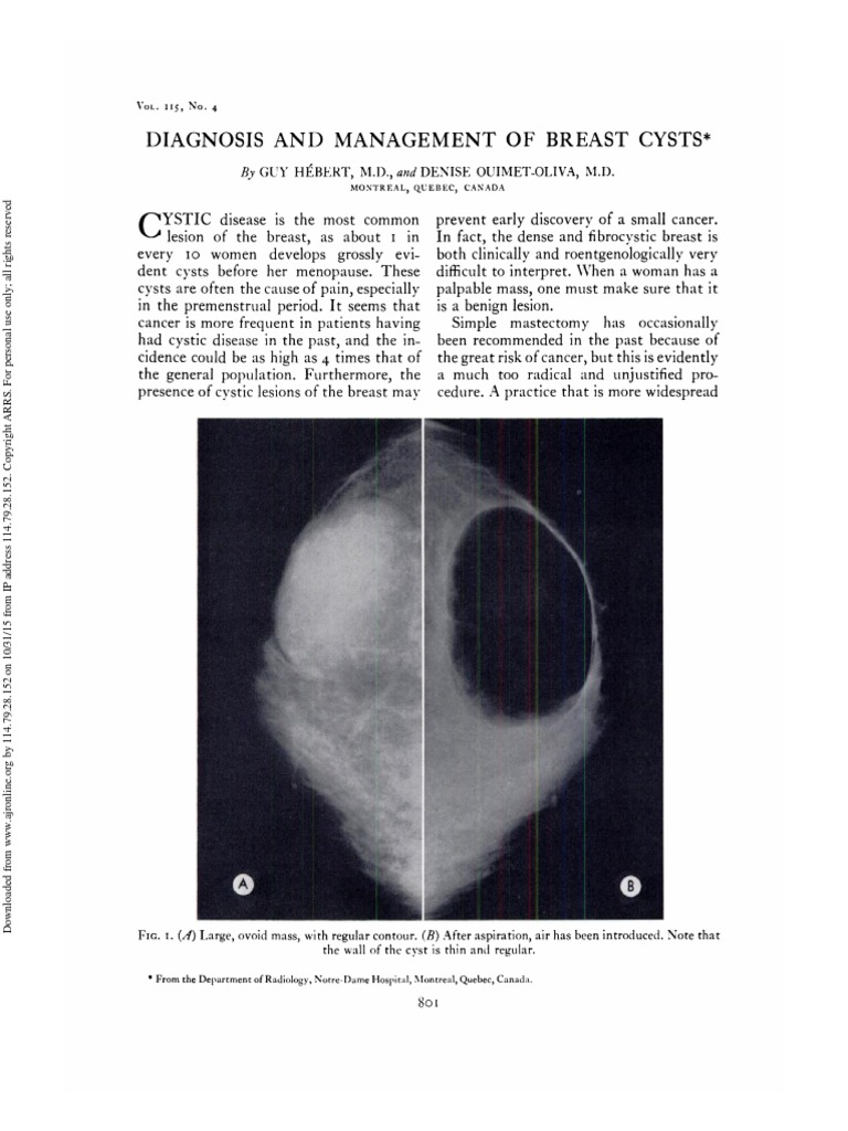 Diagnosis AND Management OF Breast Cysts | PDF | Mammography | Neoplasms