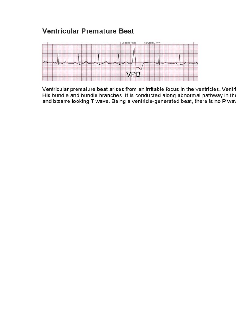 Ventricular Premature Beat | PDF