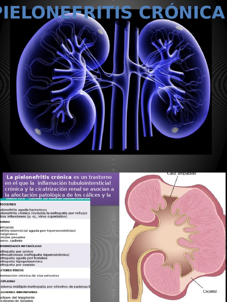 PIELONEFRITIS CRÓNICA