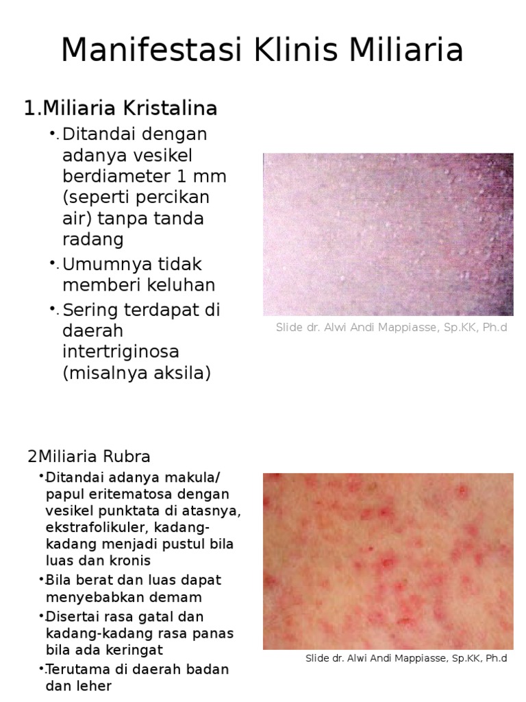 Miliaria | PDF