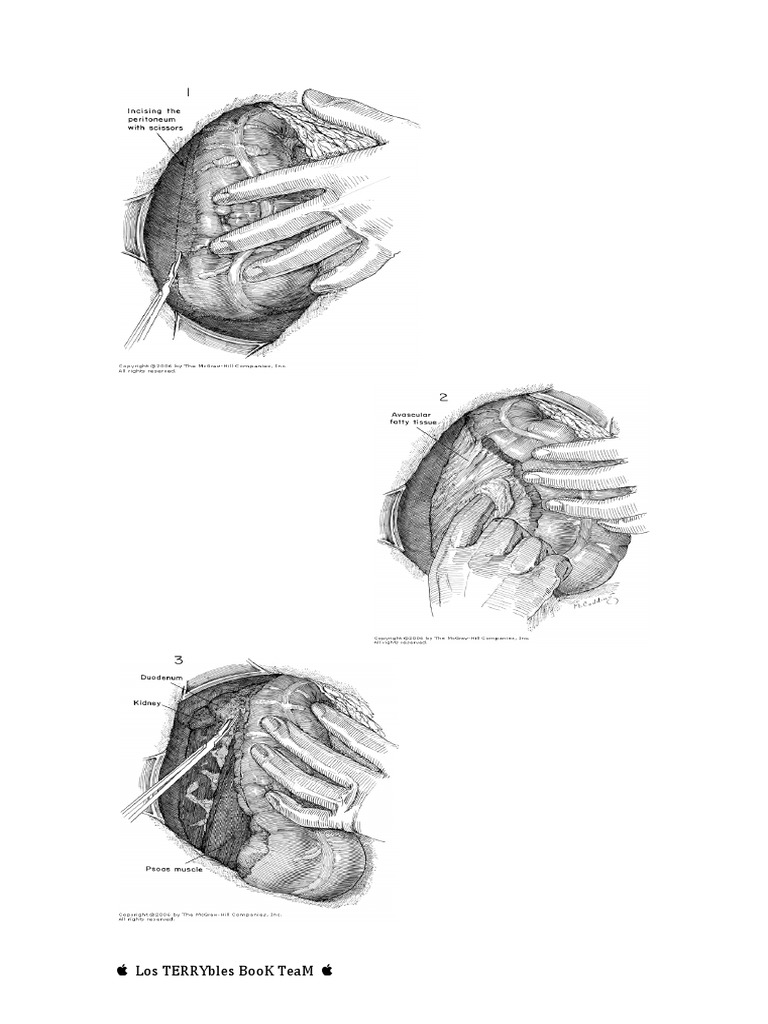 Colectomia Derecha | Large Intestine | Gastroenterology