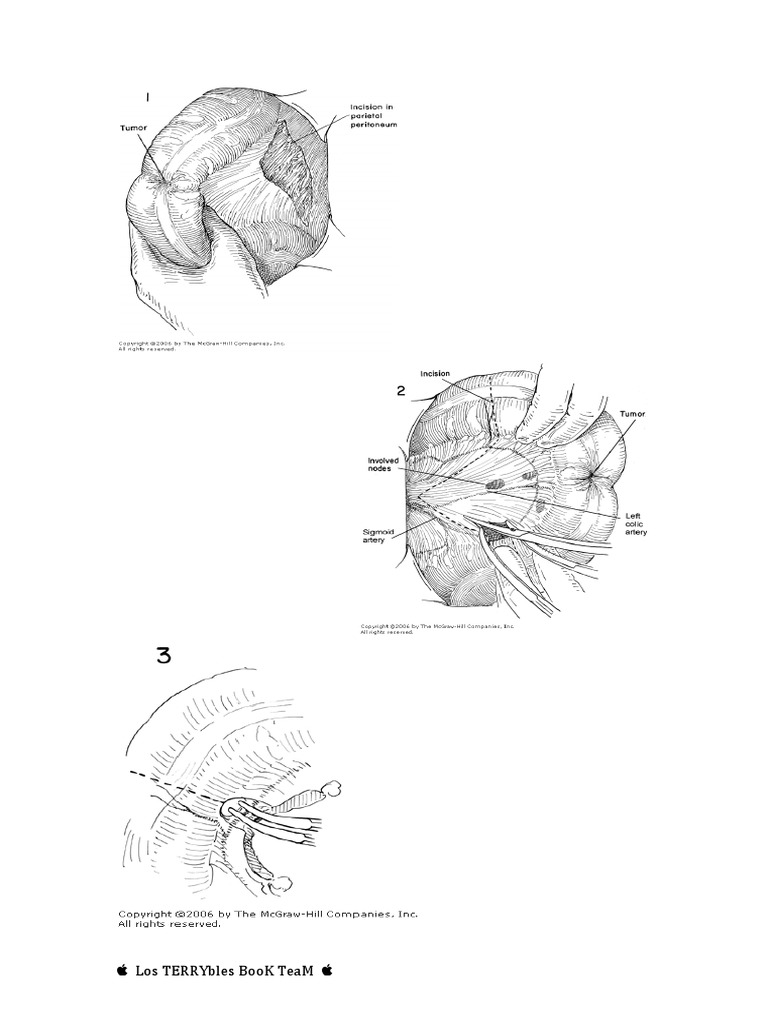 Colectomia Izquierda, Anastomosis Termino-Terminal | Large Intestine ...