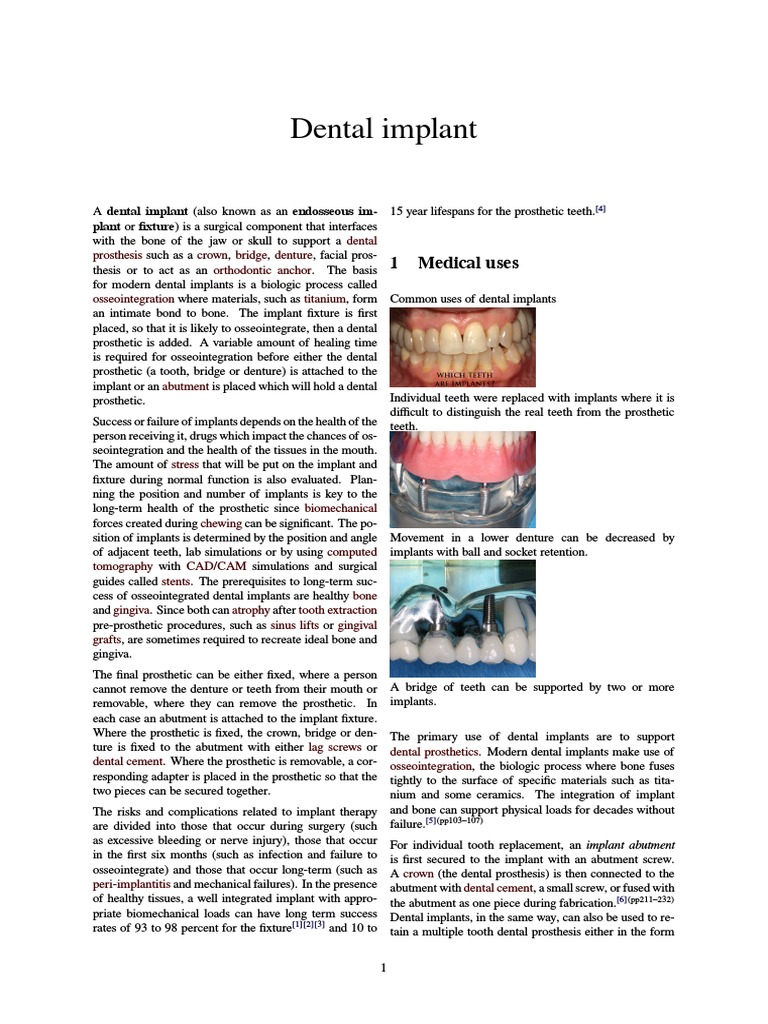 Dental Implant | PDF | Dental Implant | Dentures