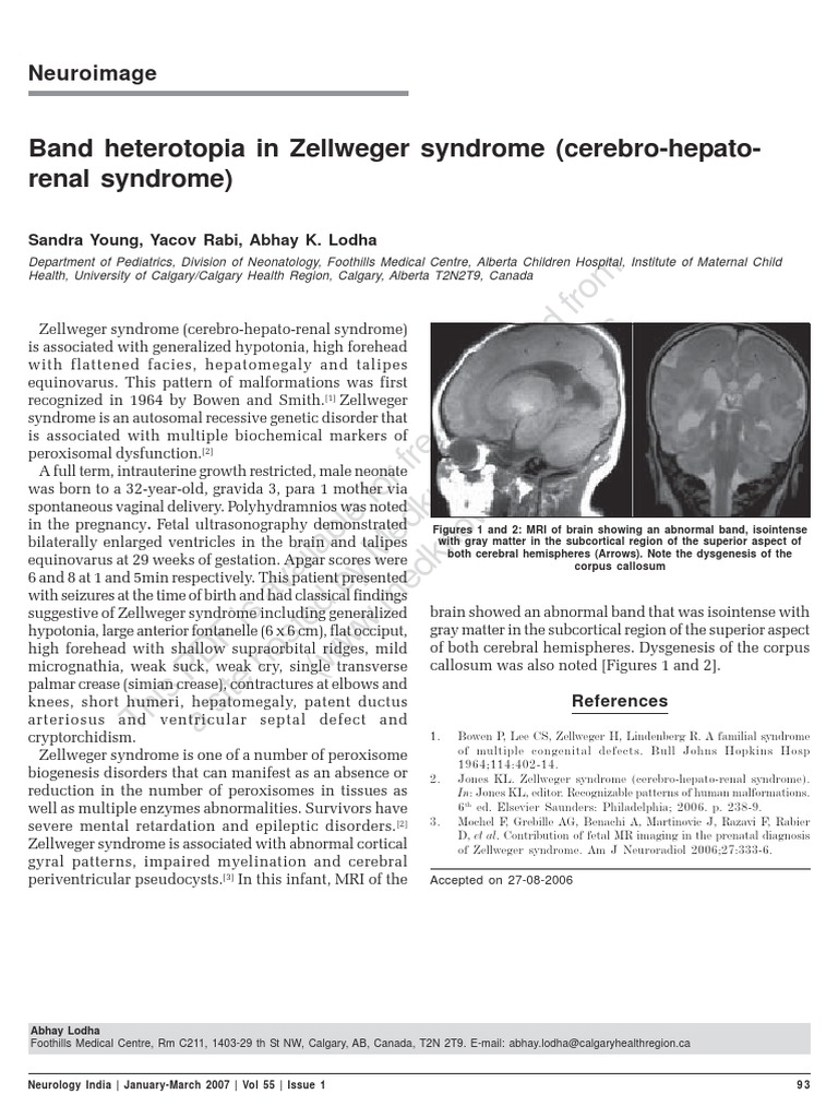 Band Heterotopia in Zellweger Syndrome (Cerebro-Hepato Renal Syndrome ...