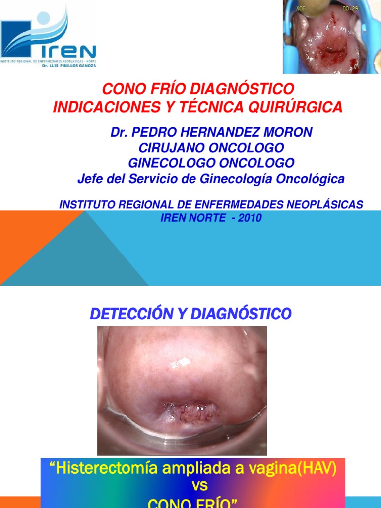 Cono Frío Diagnóstico, Cono Frío, Conización | Cáncer de cuello uterino ...