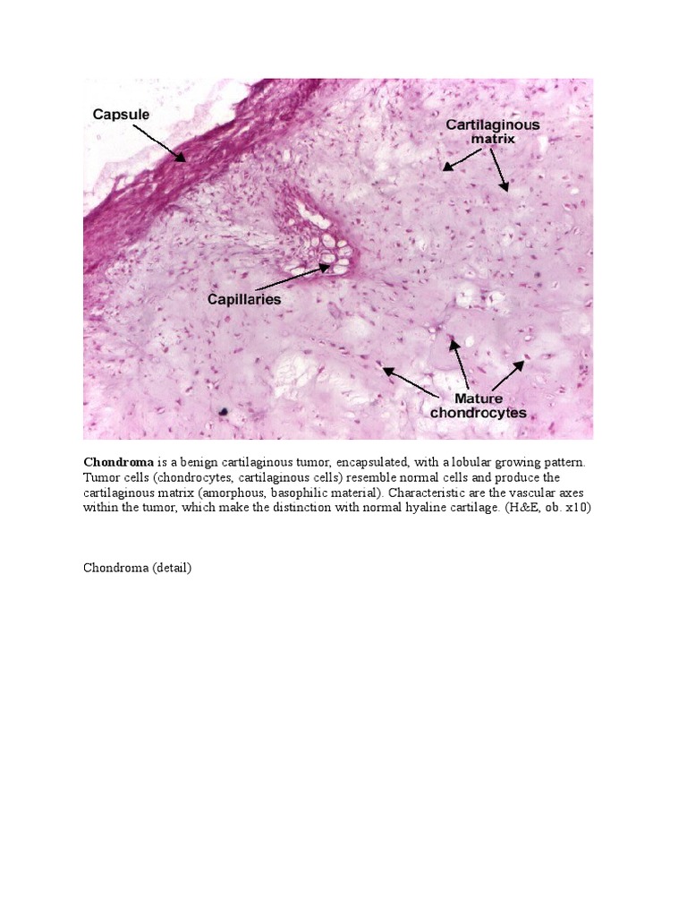 Chondroma Is A Benign Cartilaginous Tumor | PDF