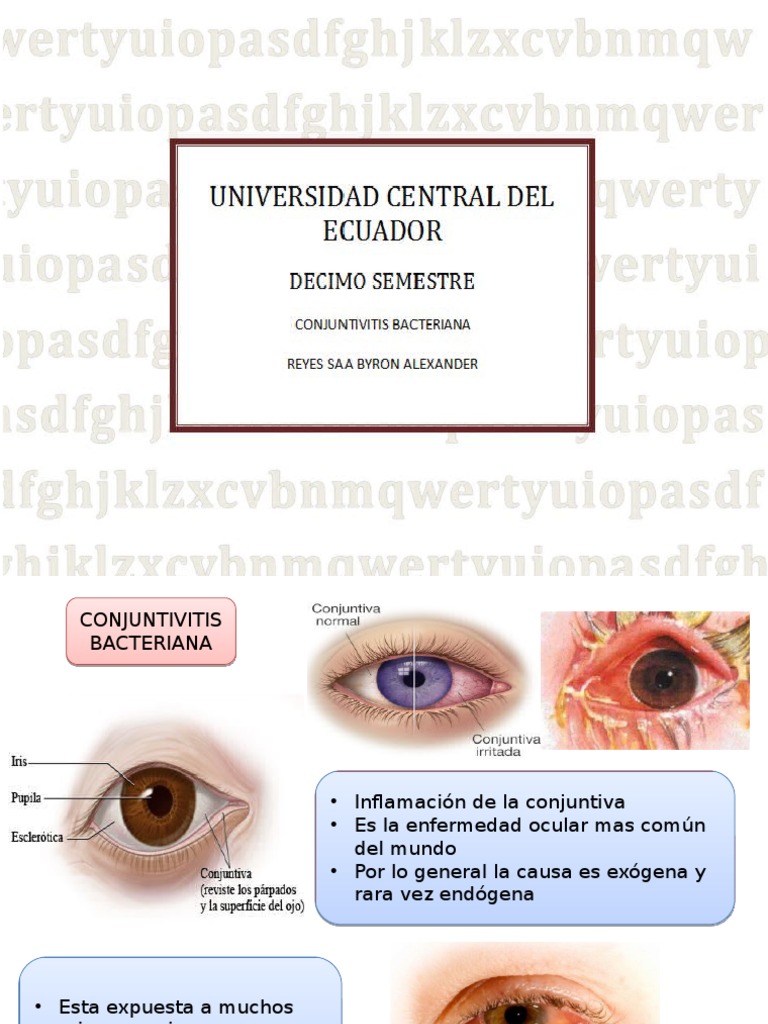 Guía de Conjuntivitis Bacteriana | PDF | Inflamación | Inmunología