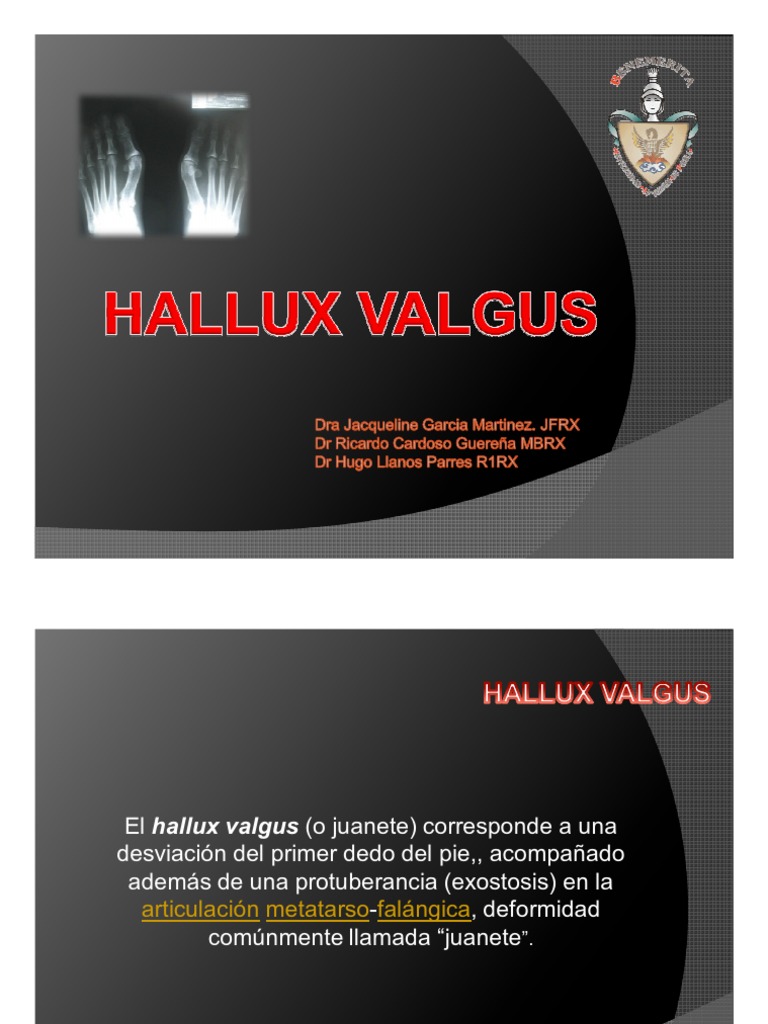 Hallux Valgus | PDF | Dedo del pie | Anatomía del miembro inferior