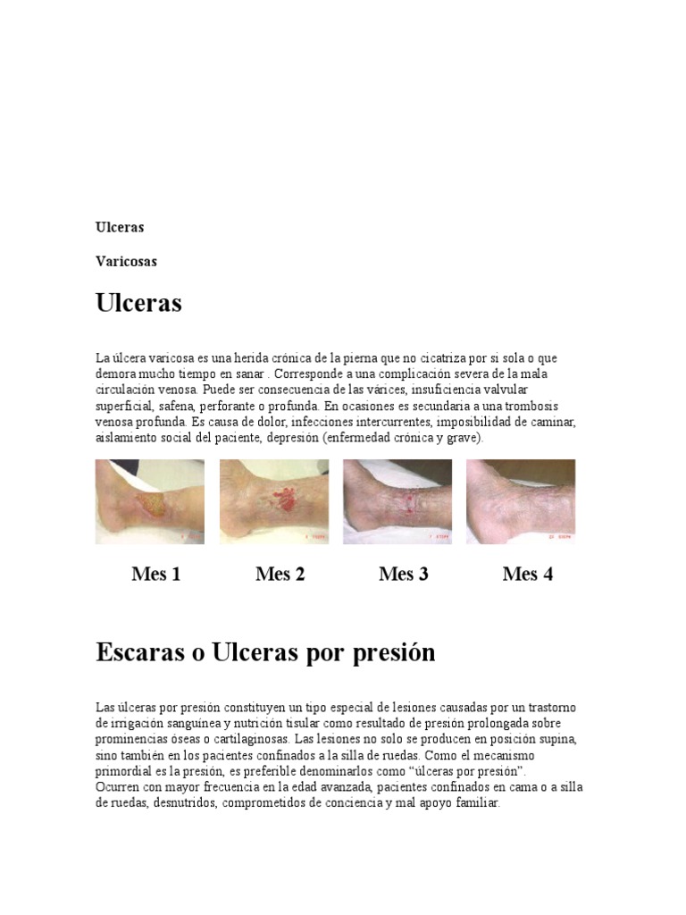 Ulceras Varicosa | Venas varicosas | Herida