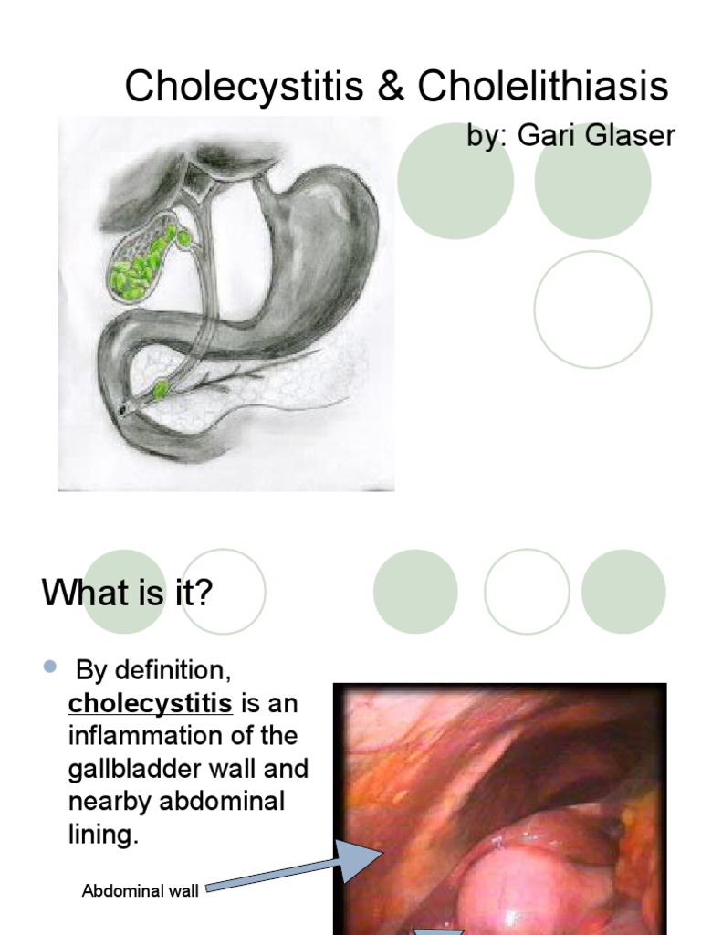 Cholecystitis and Cholelithiasis Overview | PDF
