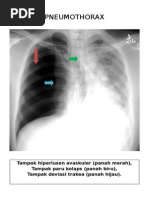 Anatomi Thorax Normal + Gambaran Radiologi | PDF