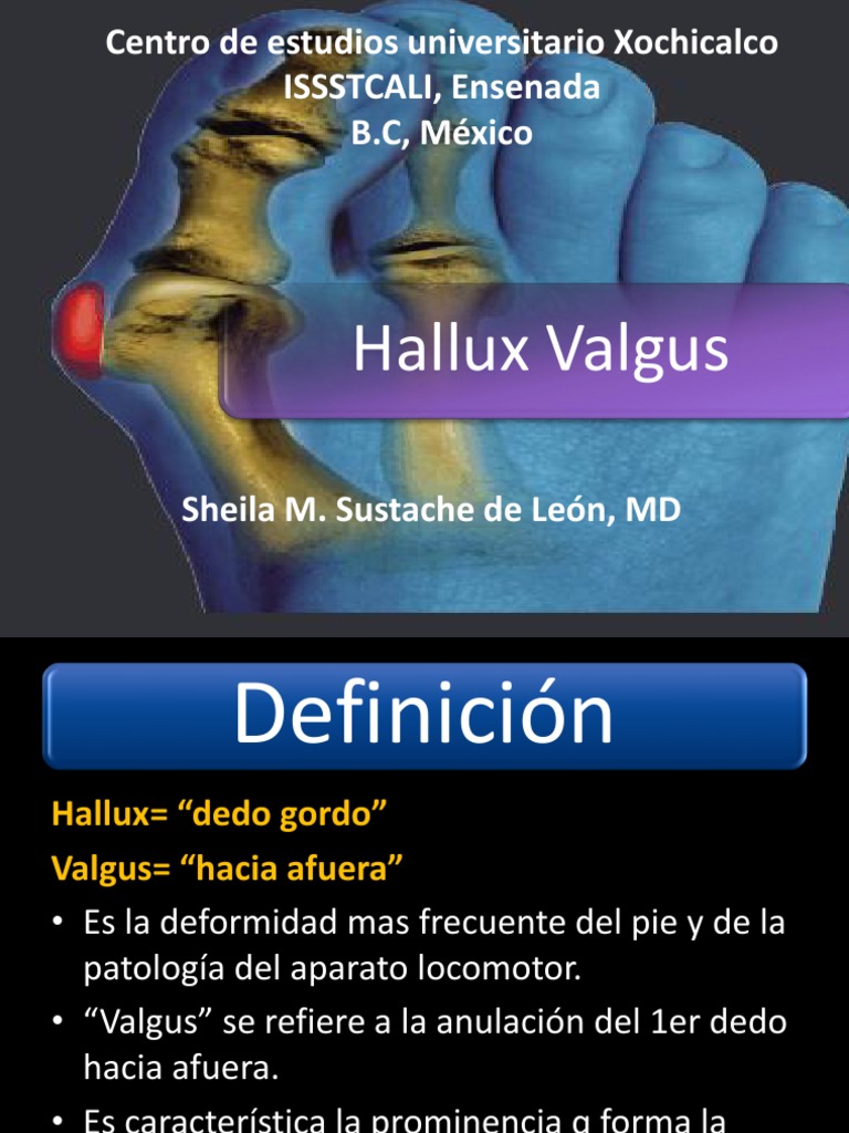 Hallux Valgus | Dedo | Pie
