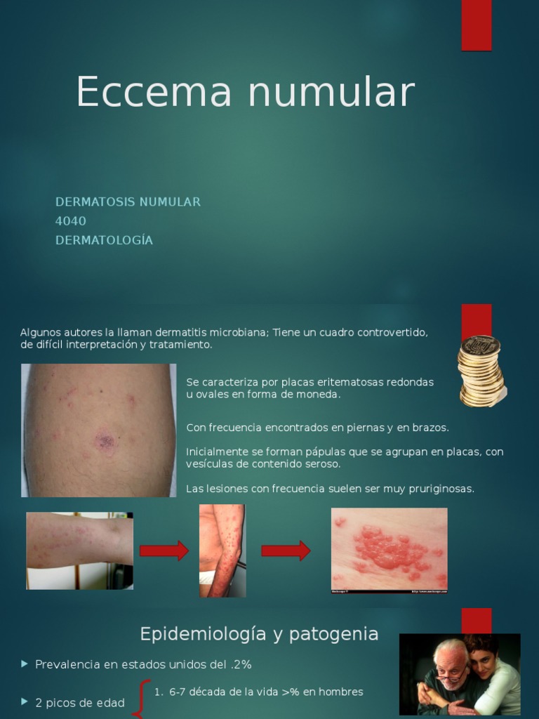 Eccema Numular | PDF | Alergia | Condiciones cutáneas