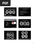 Escala ASPECTS | PDF