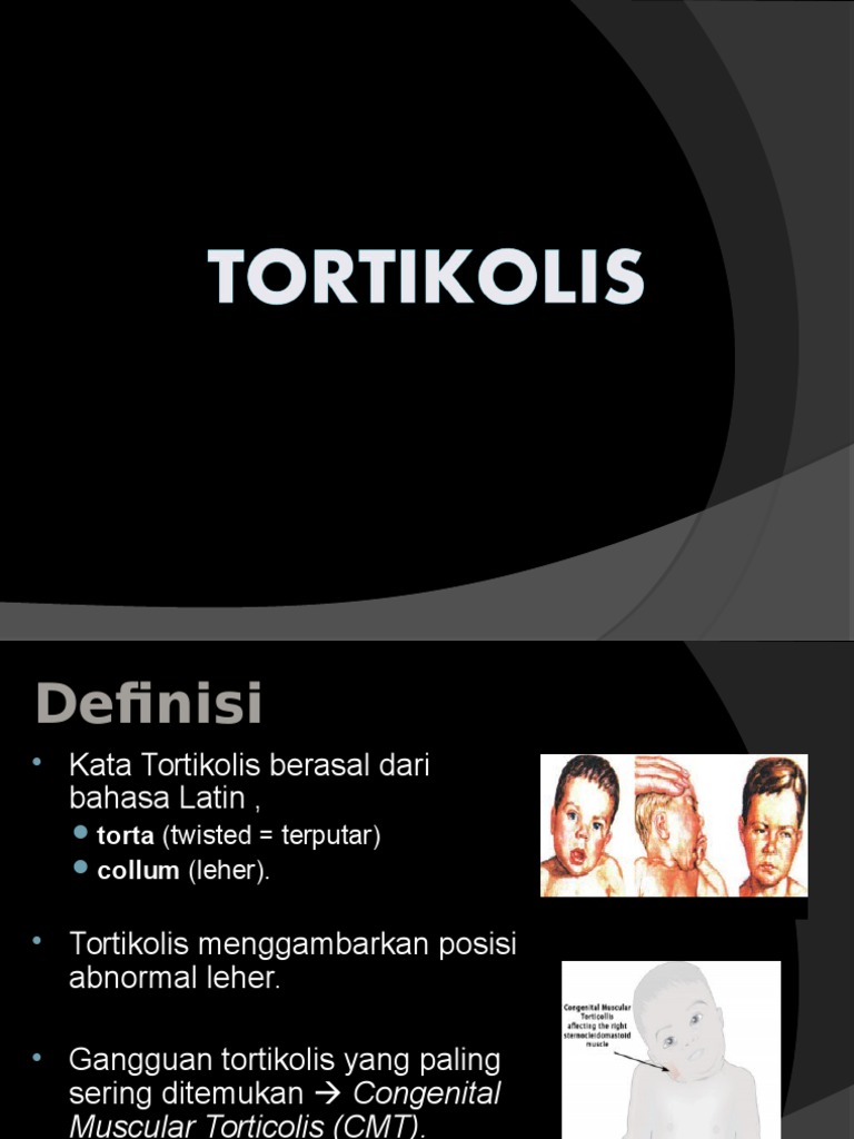 Tortikolis | PDF