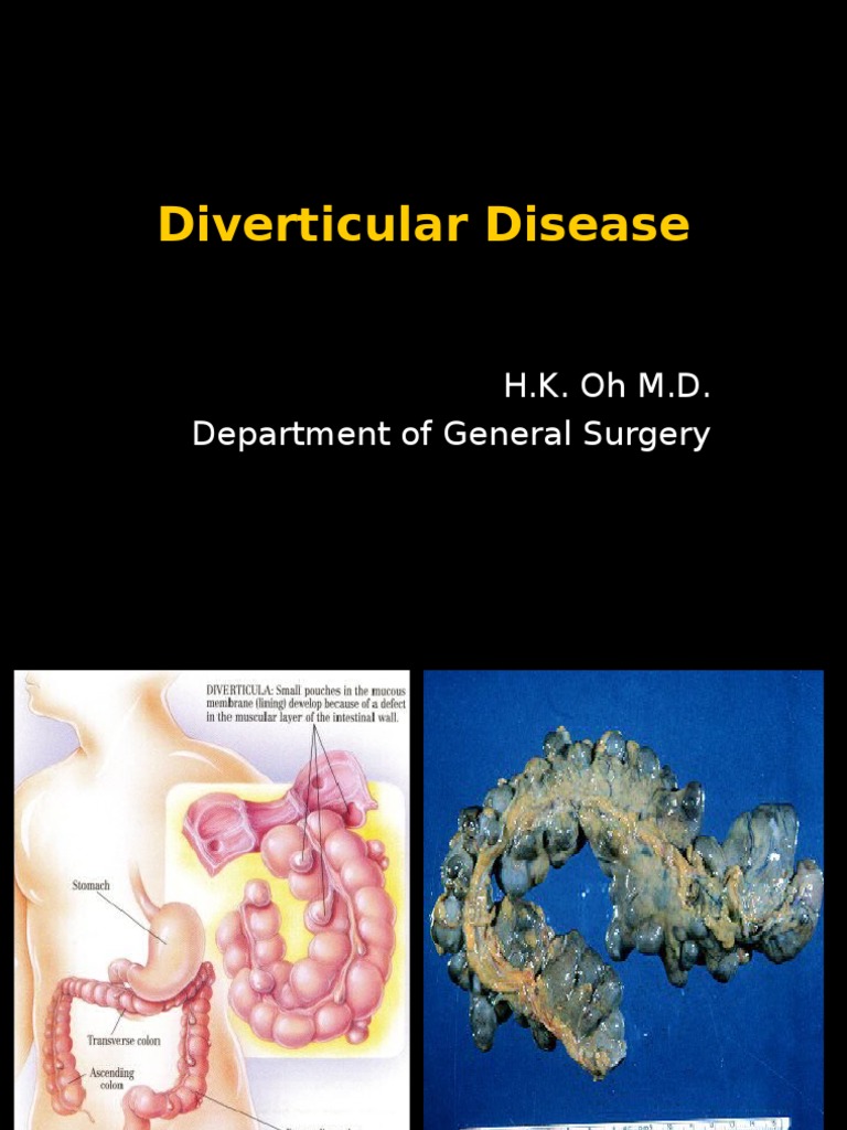 Understanding Diverticulitis and Its Complications | PDF