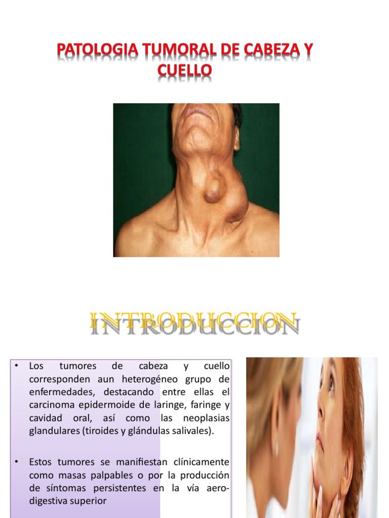 Patología tumoral de cabeza y cuello: Tumores de rinofaringe, nariz ...