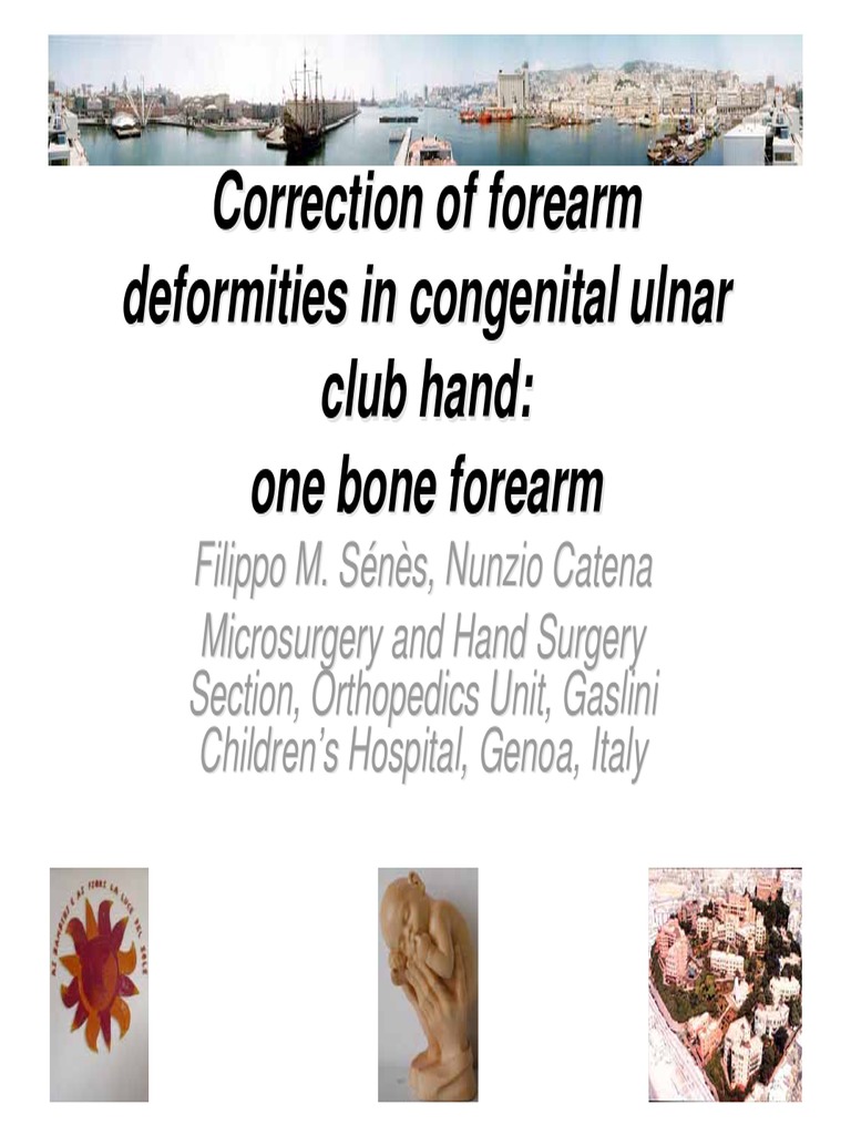 Ulnar Club Hand | Elbow | Hand