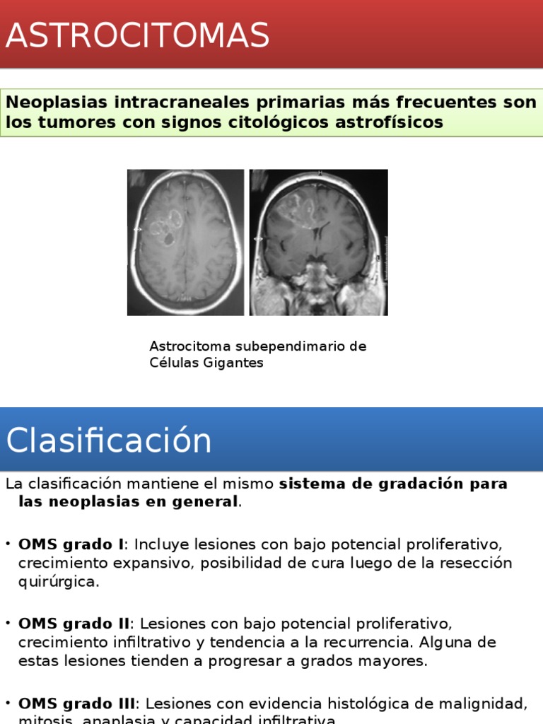 Astrocitomas | PDF | Cáncer | Ciencias de la Salud