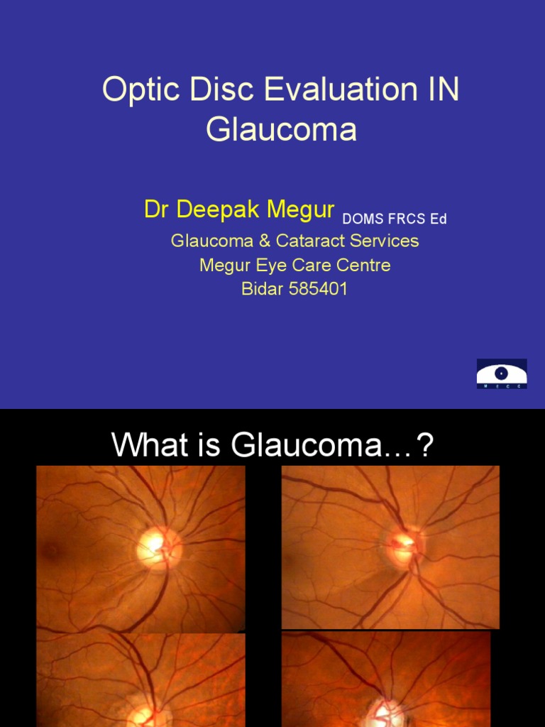 22 Optic Disc Evaluation IN Glaucoma | PDF | Retina | Glaucoma