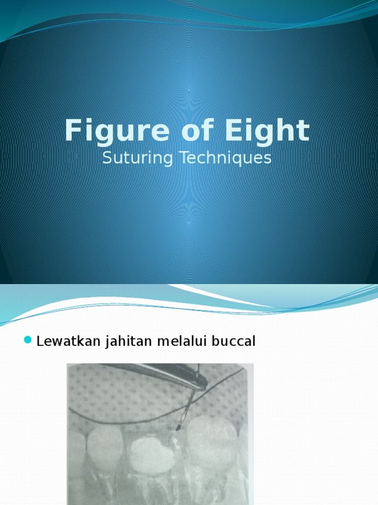 Figure of Eight Suturing | PDF