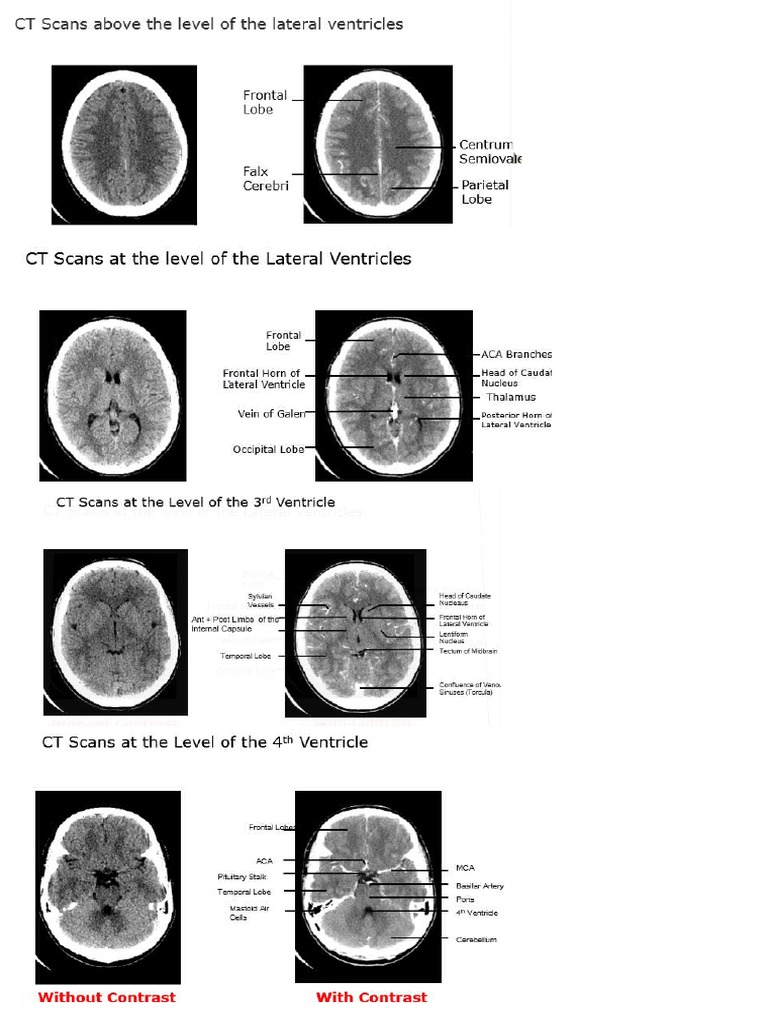 Normal CT Scan Brain | PDF