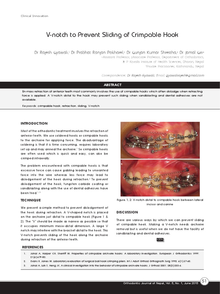 V-Notch To Prevent Sliding of Crimpable Hook | PDF | Orthodontics | Mouth