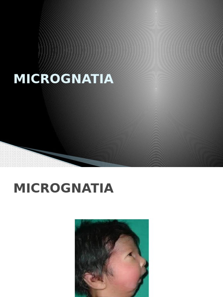 MICROGNATIA | PDF
