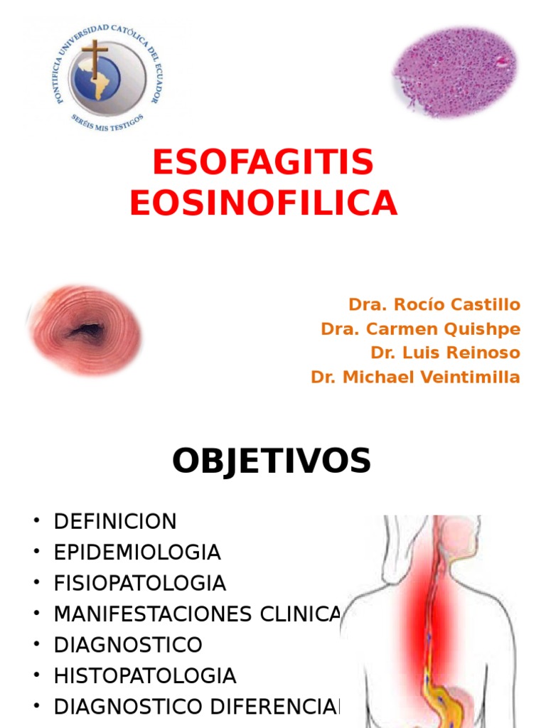 Esofagitis Eosinofilica Final | Citocina | Endoscopia