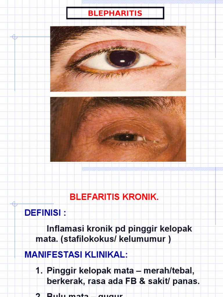 Blepharitis | PDF
