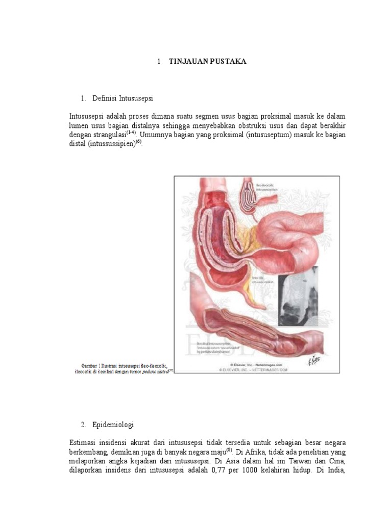 Intususepsi | PDF | Pengembangan Diri | Kesehatan Holistik