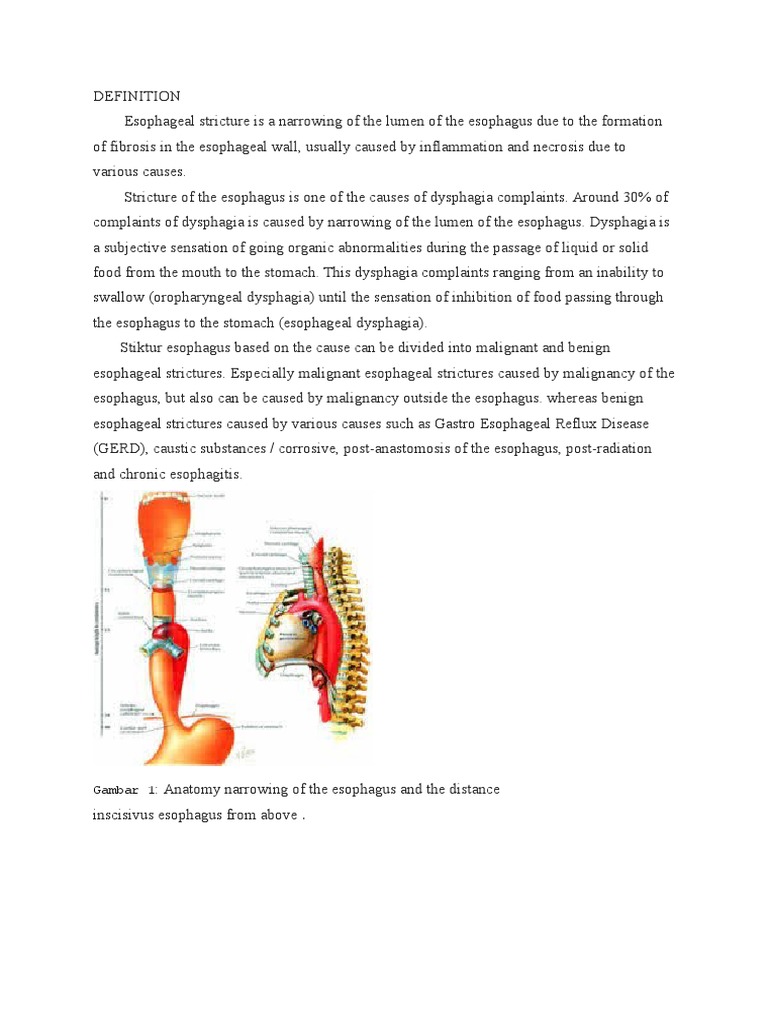 Understanding Esophageal Stricture | PDF