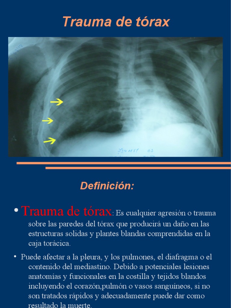 Trauma de Torax en APH | PDF | Lesión | Medicina CLINICA