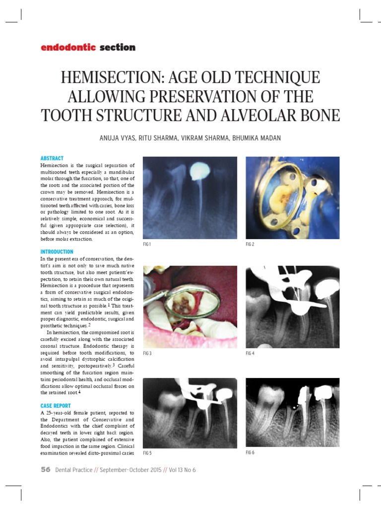 Hemisection: Age Old Technique Allowing Preservation of The Tooth ...