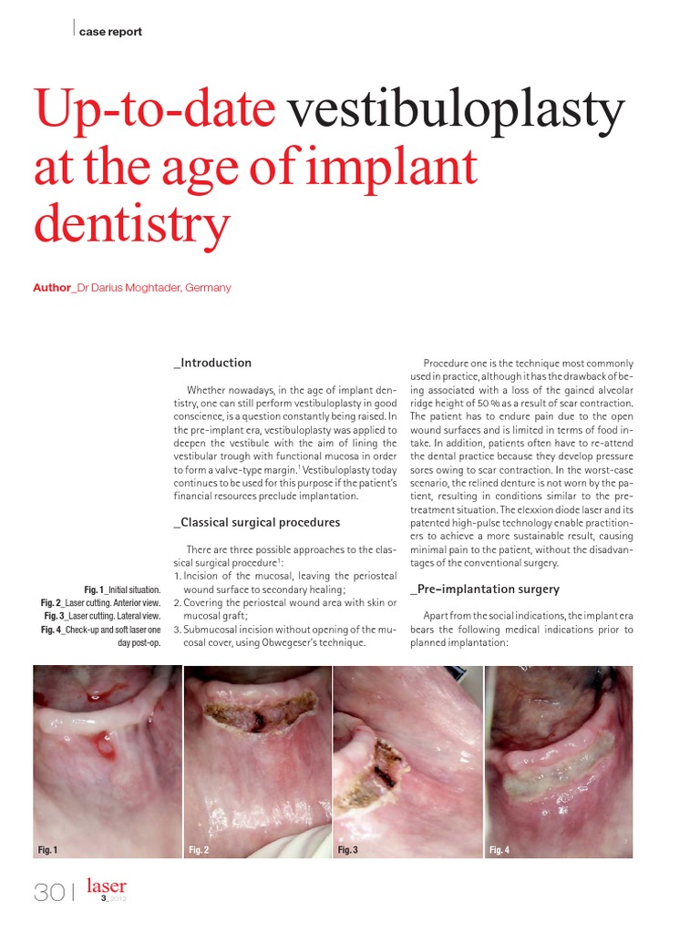 Up-To-Date at The Age of Implant Dentistry: Vestibuloplasty | PDF ...