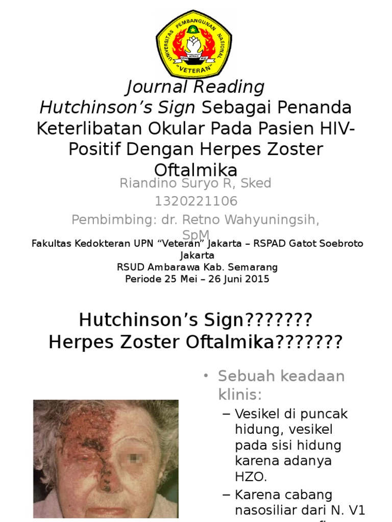 Hutchinson Sign As Marker of Ocular Involvement in HIV Positive ...