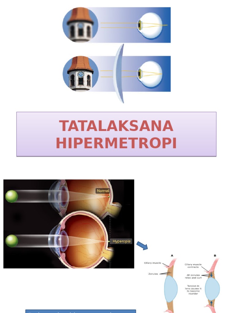 Tatalaksana Hipermetropi | PDF