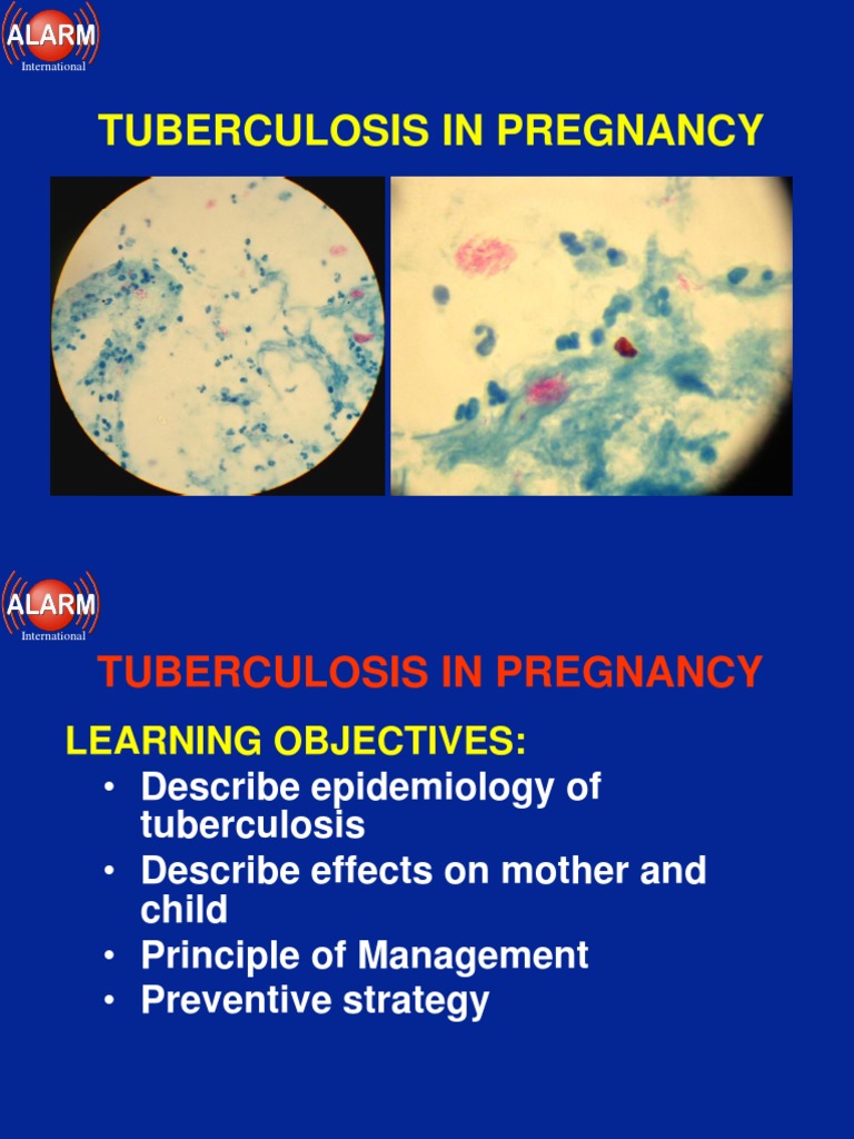 5.tuberculosis in Pregnancy | PDF | Breastfeeding | Tuberculosis