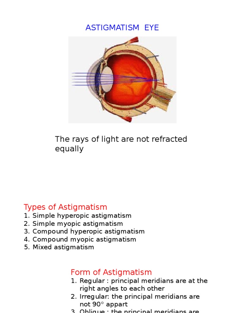 Astigmatism Eye: The Rays of Light Are Not Refracted Equally | PDF